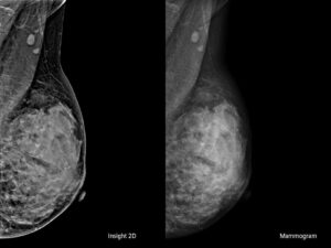 Online Mammogram Mammograpgy reporting - purdesradiology